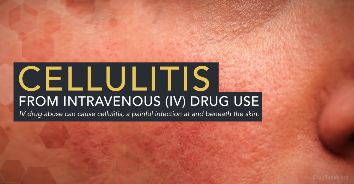 Cellulitis From Intravenous (IV) Drug Use