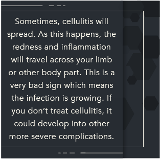 Cellulitis From Intravenous (IV) Drug Use